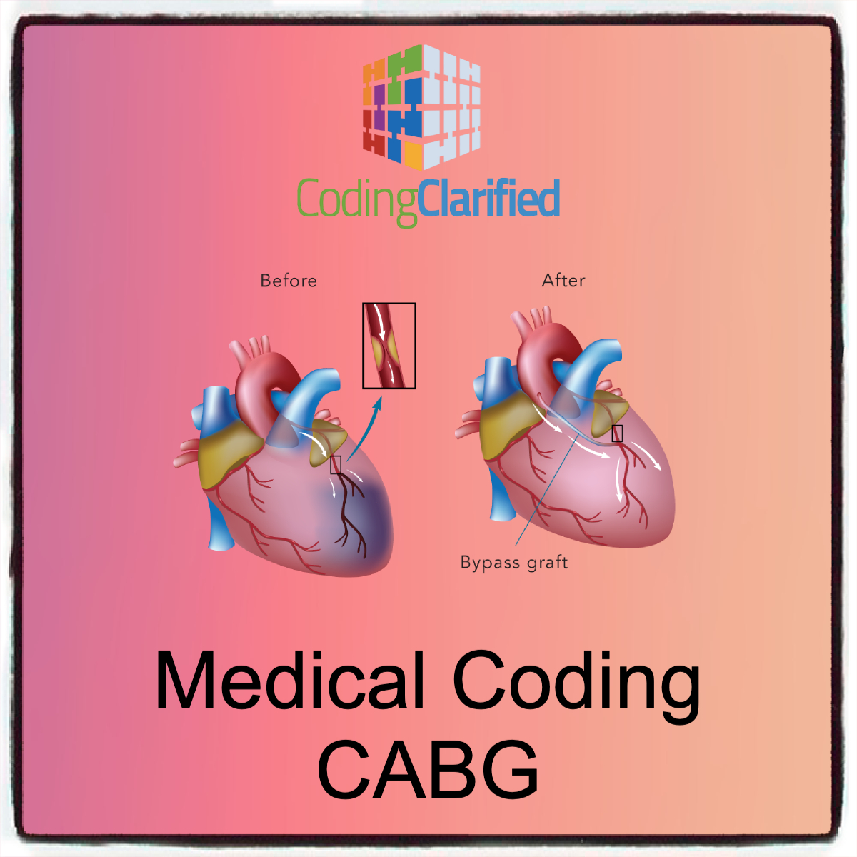 Medical Coding CABG Coding Clarified Medical Coding CABG Coding Clarified