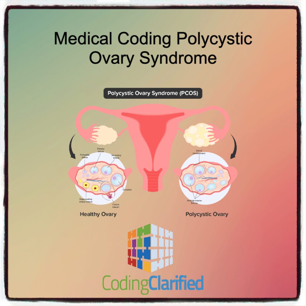 Medical Coding Polycystic Ovary Syndrome | Coding Clarified